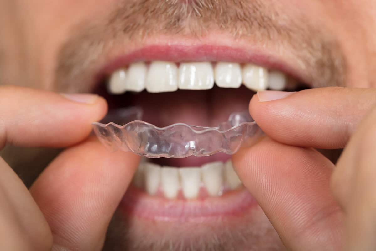 How Do You Clean Your Invisalign Retainers? - Imperial Dental Associates